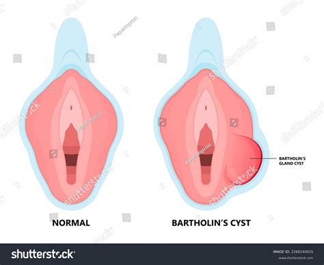 Bartholins Cyst Vagina Pain Lump Mass Stock Vector Royalty Free