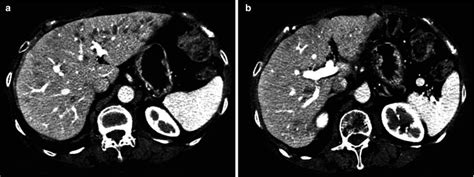 Diffuse Liver Disease Radiology Key Diffuse Liver Disease Radiology Key