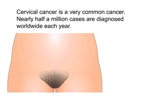 Cervical Cancer