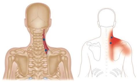 Taping For Trigger Points Levator Scapulae Trigger Point Therapy Trigger Points Scapula
