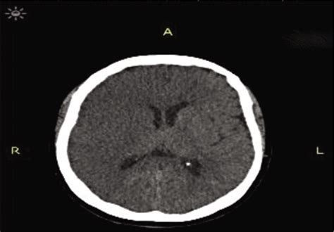Surgical Neurology International