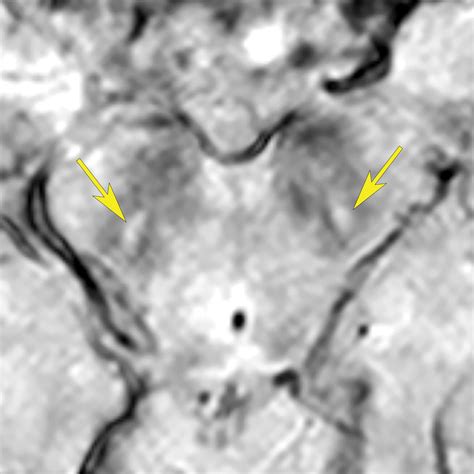 Imaging The Substantia Nigra In Parkinson Disease And Other