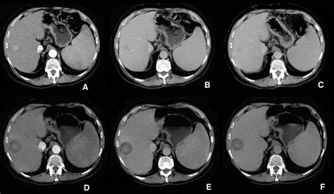Computed Tomography Ct Scans In A 56 Year Old Man With A