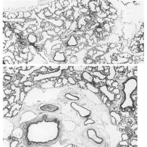 An Extralobar Sequestration At Left Is Located Behind The Hypoplastic Download Scientific