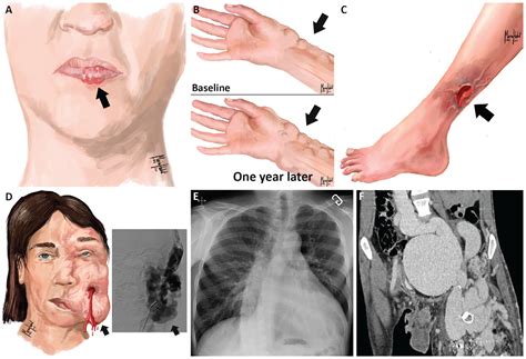 Embolization Of Extracranial Arteriovenous Malformations
