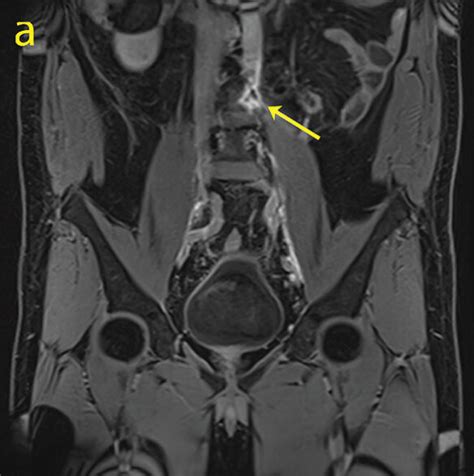 Magnetic Resonance Lymphangiogram With Lipiodol Dynamic Download