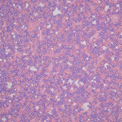 Thyroid Lesion Stock Illustrations 3 Thyroid Lesion Stock Illustrations Vectors And Clipart