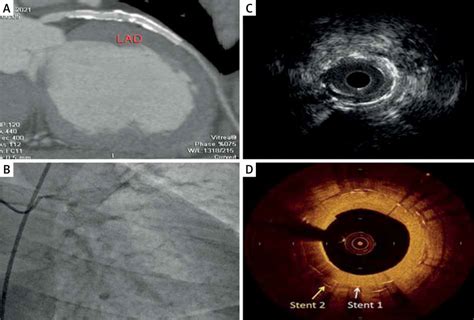 Different Types Of Atherectomy Devices A Rotapro Atherectomy System Download Scientific