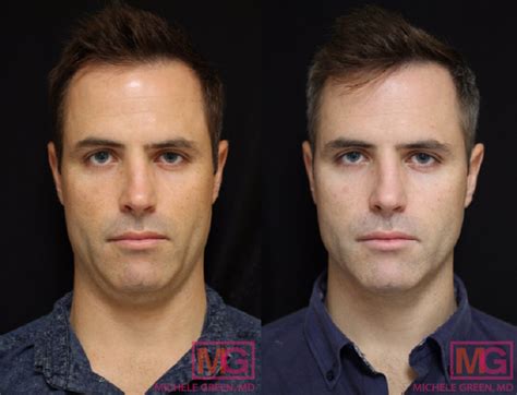 Coolsculpting Before And After Photos Neck Chin Stomach