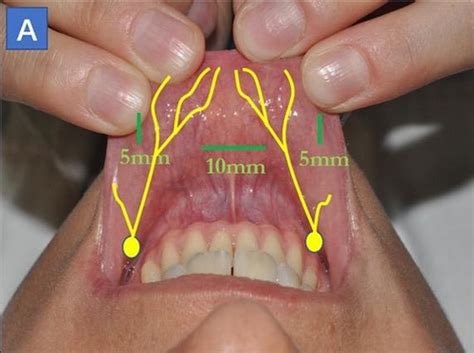 Oral Soft Tissue Biopsy Techniques And Guidelines Flashcards Quizlet