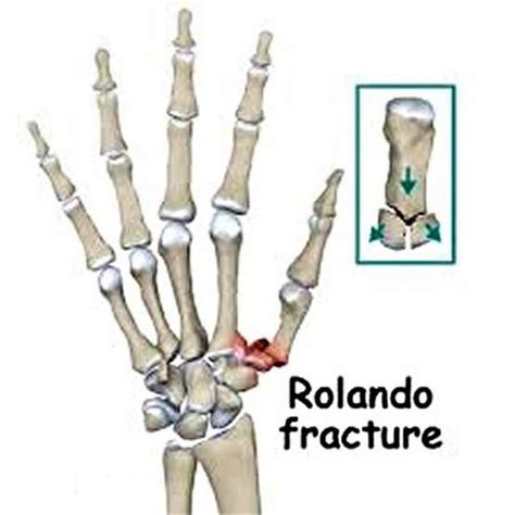 Rolando Fracture Thumb Fractures And Dislocations Practice