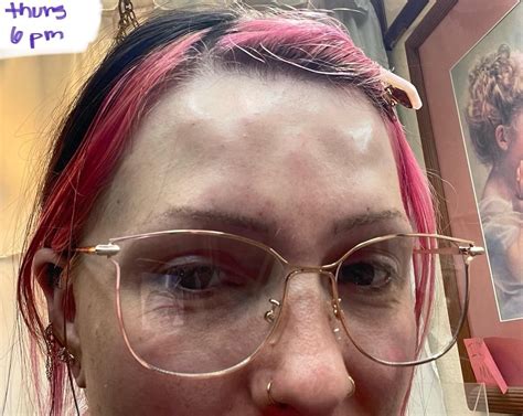 Bad Botox Side Effect R30plusskincare