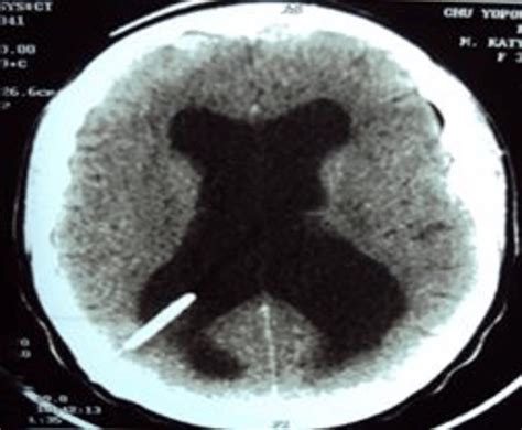 Head Ct Scan Showing Ventricular Dilation Download Scientific Diagram