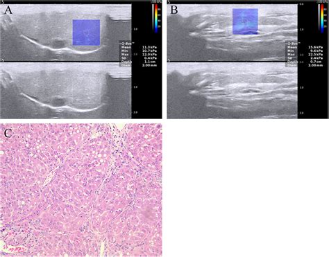 Two Dimensional Shear Wave Elastography 2d Swe Measurement Of The A