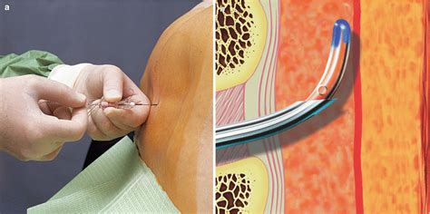 Combined Spinal And Epidural Anesthesia Cse Anesthesia Key