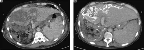 Graft Calcification Caused By A Torsion Of The Hepatic Vein After A