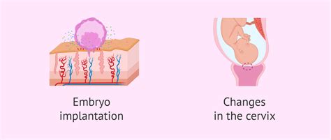Causes Of Decidual Bleeding In Pregnancy