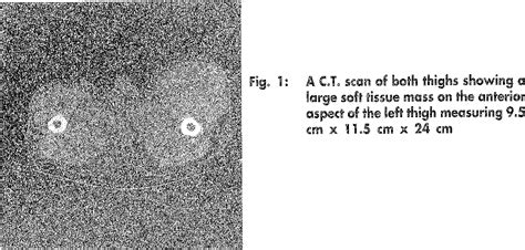 Figure 1 From Extraskeletal Osteosarcoma Of The Thigh Semantic Scholar