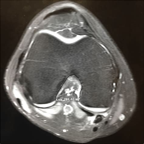 The Axial Slice Of The Knee Mri Shows The Measurement Of Femoral Download Scientific Diagram