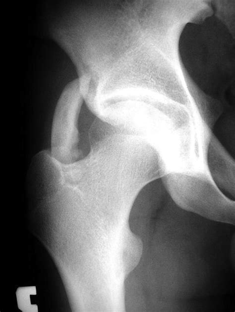 Abbreviations Aiis Anterior Inferior Iliac Spine Mri Magnetic Resonance