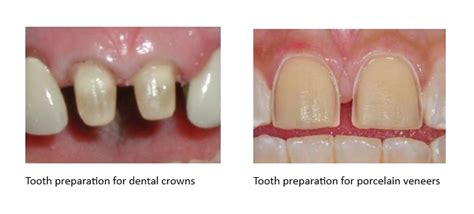 360 Veneers Are Not Porcelain Veneers Poplar Crossing Dental