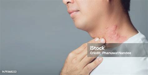 Close Up Man Having Red Papules Itchy Rash And Scratching His Neck Skin Allergy Symptoms From Close Up Man Having Red Papules Itchy Rash And Scratching His Neck Skin Allergy Symptoms From