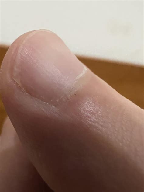 Worried R Scleroderma