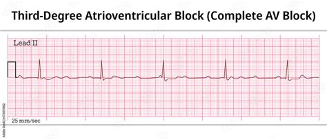 Ecg Third Degree Atrioventricular Block Complete Av Block 8 Second Ecg Paper
