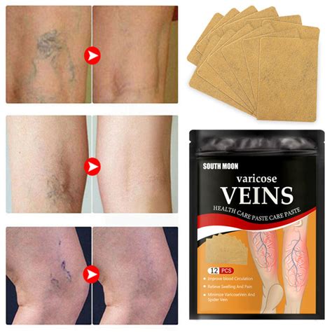 12pcs Varicose Veins Relief Patch Phlebitis Vasculitis Treatment