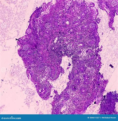 Chronic Nonspecific Ileitis Section Show Ileal Mucosa In Lamina