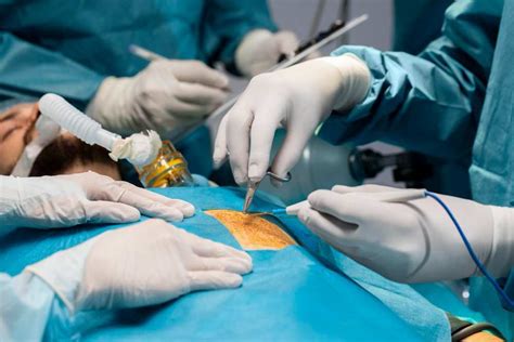 Laparoscopic Cholecystectomy Laparoscopic Gallbladder Surgery