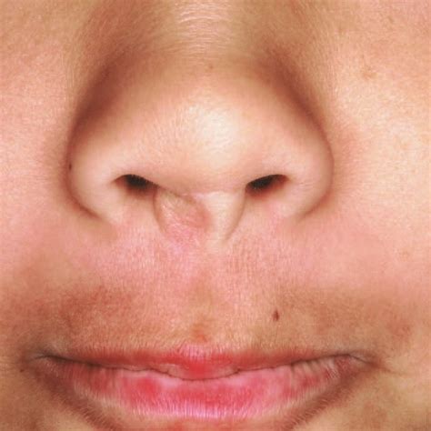 Collapse Or Contracture Of The Columella Is Evident Predominantly On Download Scientific