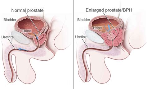 Benign Prostatic Hypertrophy Causes Symptoms Diagnosis And Treatment