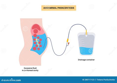 Abdominal Paracentesis Poster Cartoon Vector 281039655
