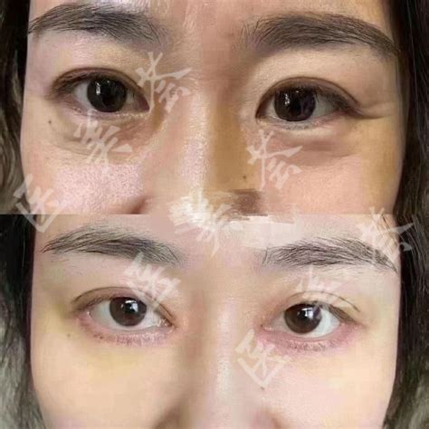 眼袋做后对比图 眼袋对比 去眼袋对比 第9页 大山谷图库