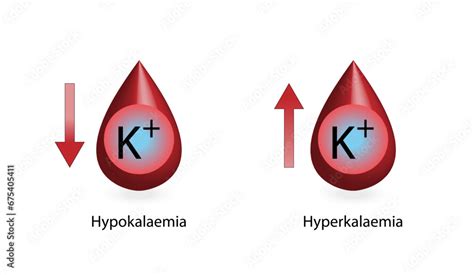 Hyperkalaemia High Plasma Potassium Level And Hypokalaemia Low Plasma Potassium Level