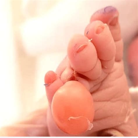 Dorsal View Of The Left Foot Shows Marked Constriction Ring At The