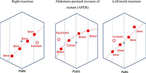 Standard Robotic Port Configuration Download Scientific Diagram