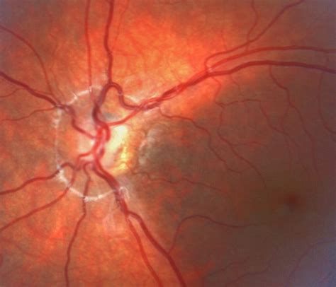 Optic Nerve Hypoplasia Retinara