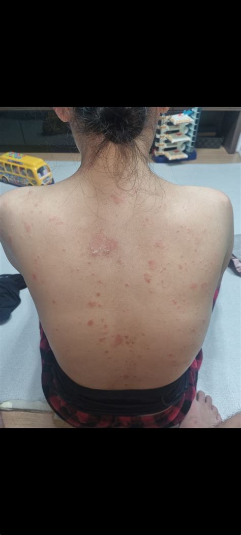 건선인지 습진인지 알레르기성 피부염인지 봐주세요ㅜㅜ 지식in