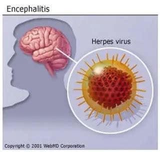 Encephalitis Causes And Risk Factors