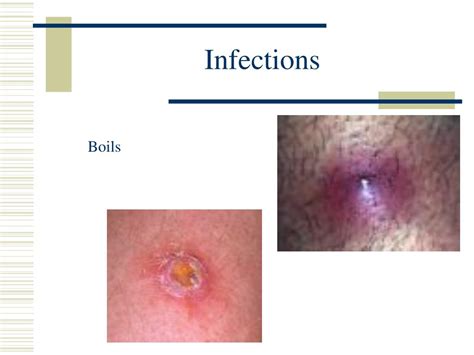 Ppt Mrsa Powerpoint Presentation Free Download Id1758420