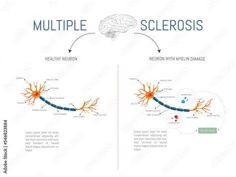 Infographic Of A Healthy Neuron And One With Damage From Attack By