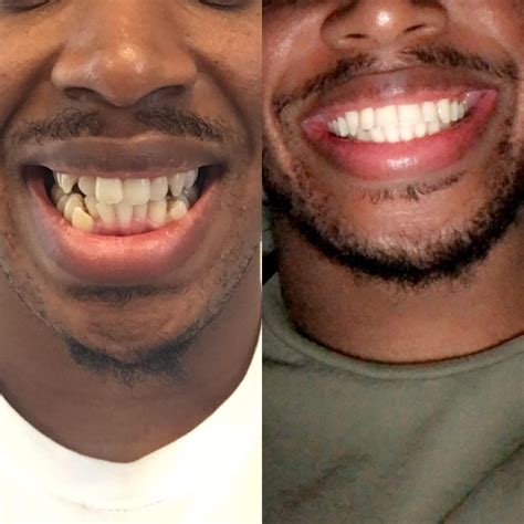 Best R Braces Images On Pholder Officially In My Forever Retainers