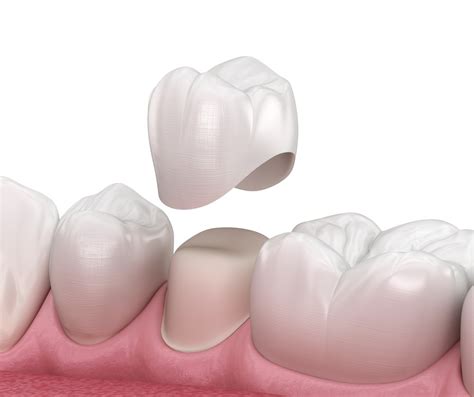 Different Types Of Dental Crowns 2024 Ilajak Medical