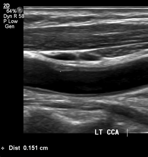 경동맥 초음파 경동맥 협착 내중막 두께 증가와 동맥경화반의 치료 네이버 블로그