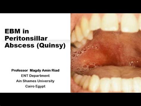 Ebm In Peritonsillar Abscess Quinsy Magdy Amin Riad Posted On The Topic Linkedin