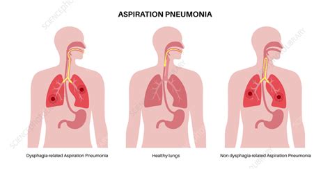 Aspiration Pneumonia Illustration Stock Image F0440040 Science