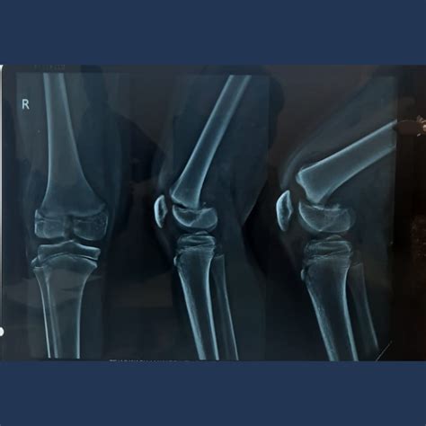 Limb Deformity Sankalp Ortho Clinic