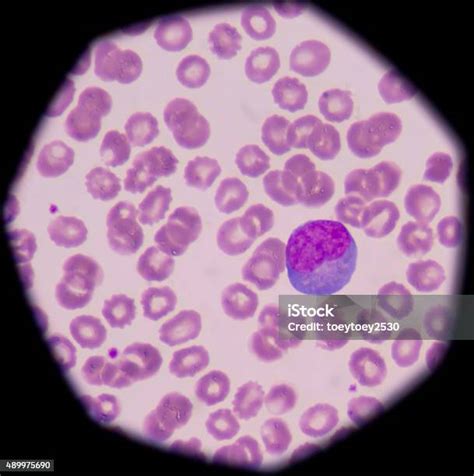 Limfosit Reaktif Adalah Limfosit Foto Stok Unduh Gambar Sekarang